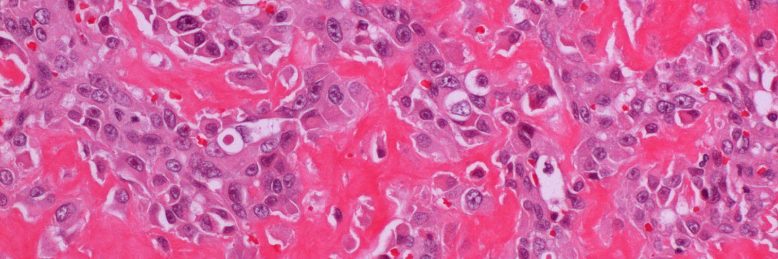 Transitional cell carcinoma (TCC) in a dog | Case Study | Cytopath