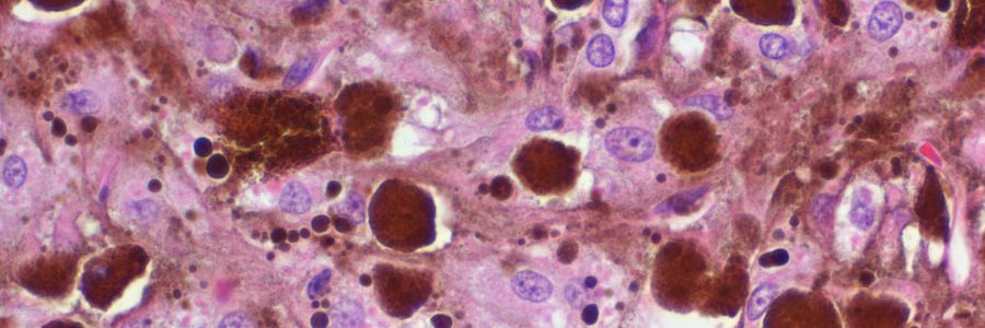 Ophthalmic Pathology | Cytopath